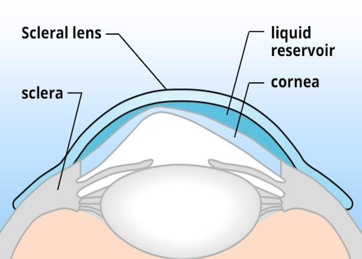 Scleral lens fitting at NJ Vision and Dry Eye Center in Old Bridge